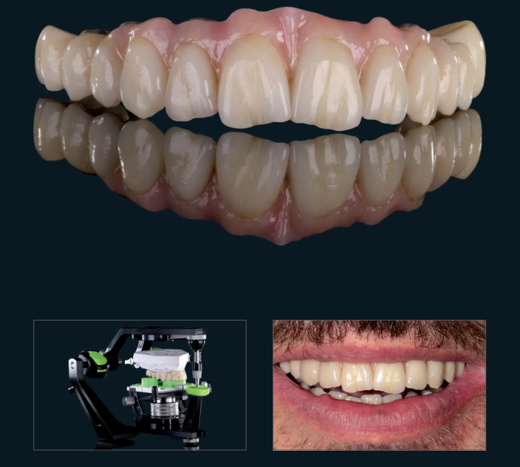 Zirkonzahn泽康赞—璞睿陶无牙颌全口修复 - 茵伯特